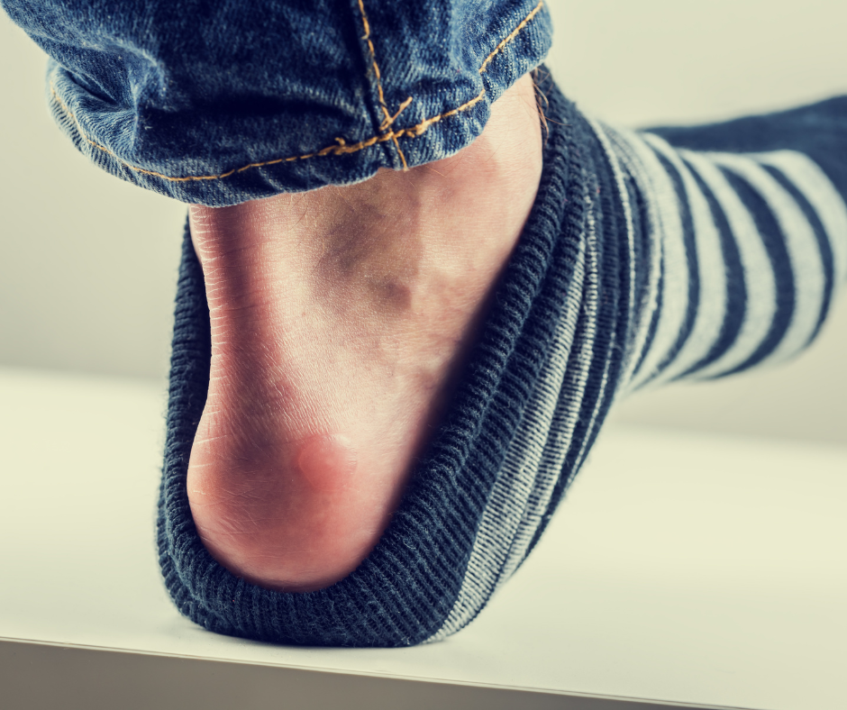 Blisters: Causes and Prevention - Nexus Foot & Ankle - New Jersey ...