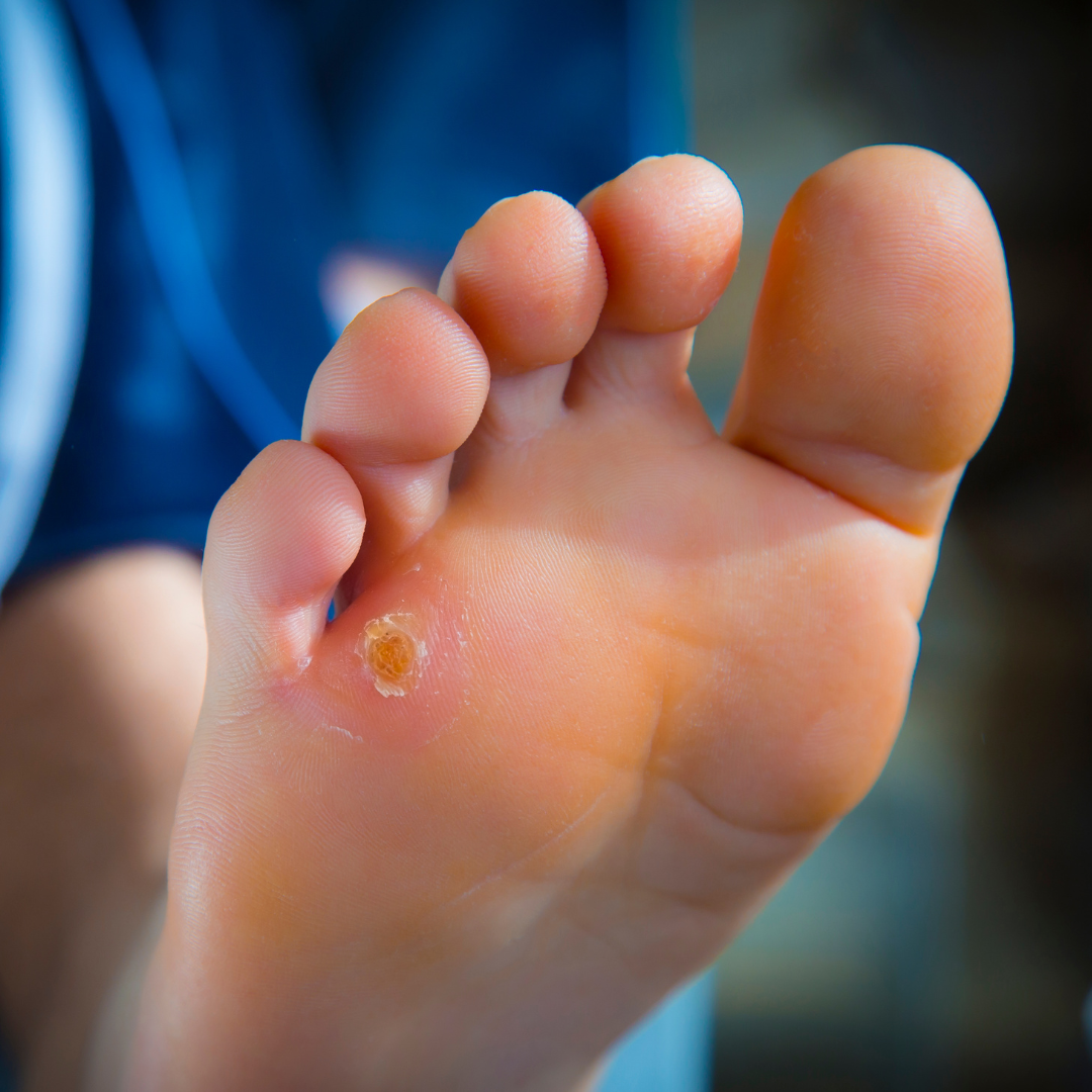 What Are Corns And Calluses? - New Jersey Podiatric Physicians ...