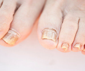 Complications of Toenail Fungus: What You Need to Know - Nexus Foot ...